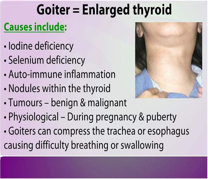 Thyroid Goiter - Causes, Symptoms, Treatment, Diagnosis and Prevention ... Thyroid Goiter - Causes, Symptoms, Treatment, Diagnosis and Prevention ...